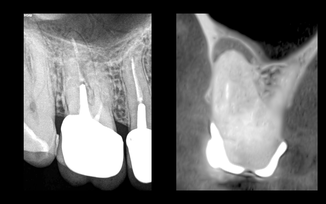 Cas de canal non traité - Dr Brice Riera