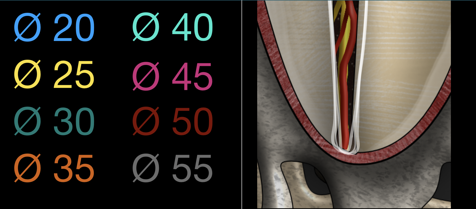 Les conséquences d'un mauvais choix de diamètre apical - Dr Brice Riera