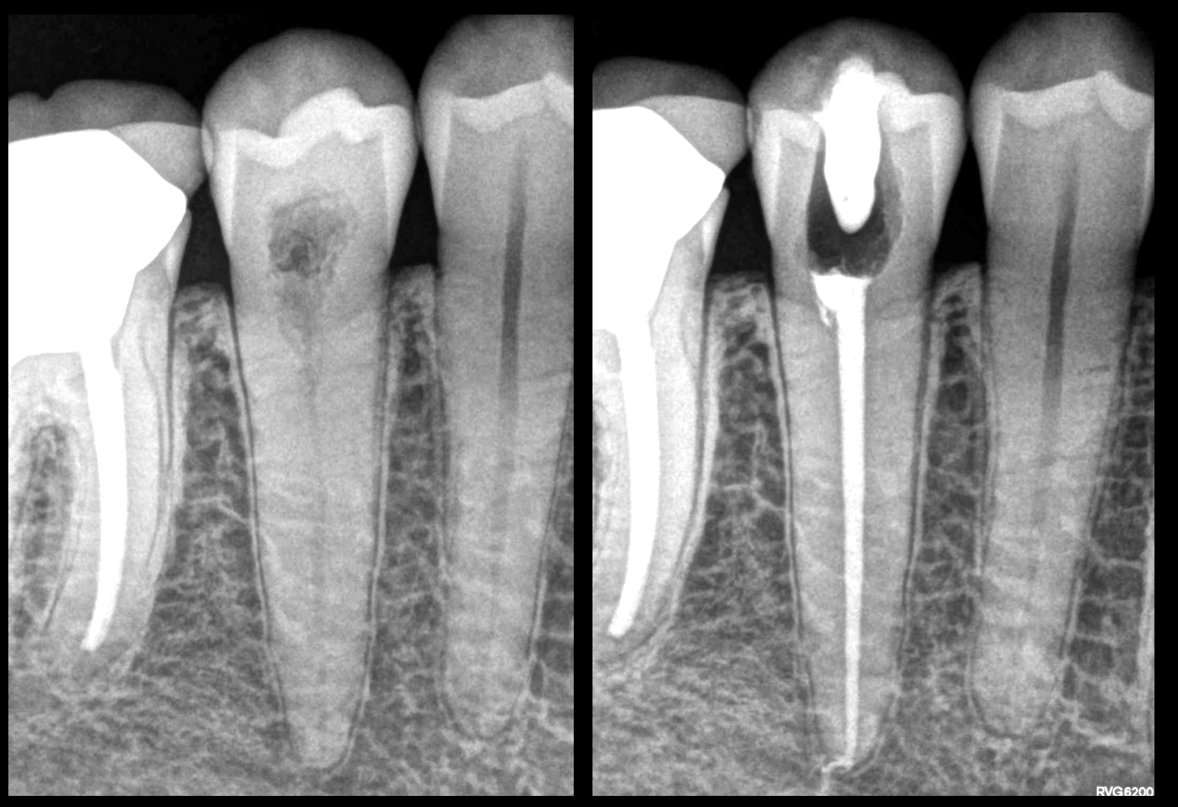 Résorption radiculaire externe cervicale - Dr Brice Riera