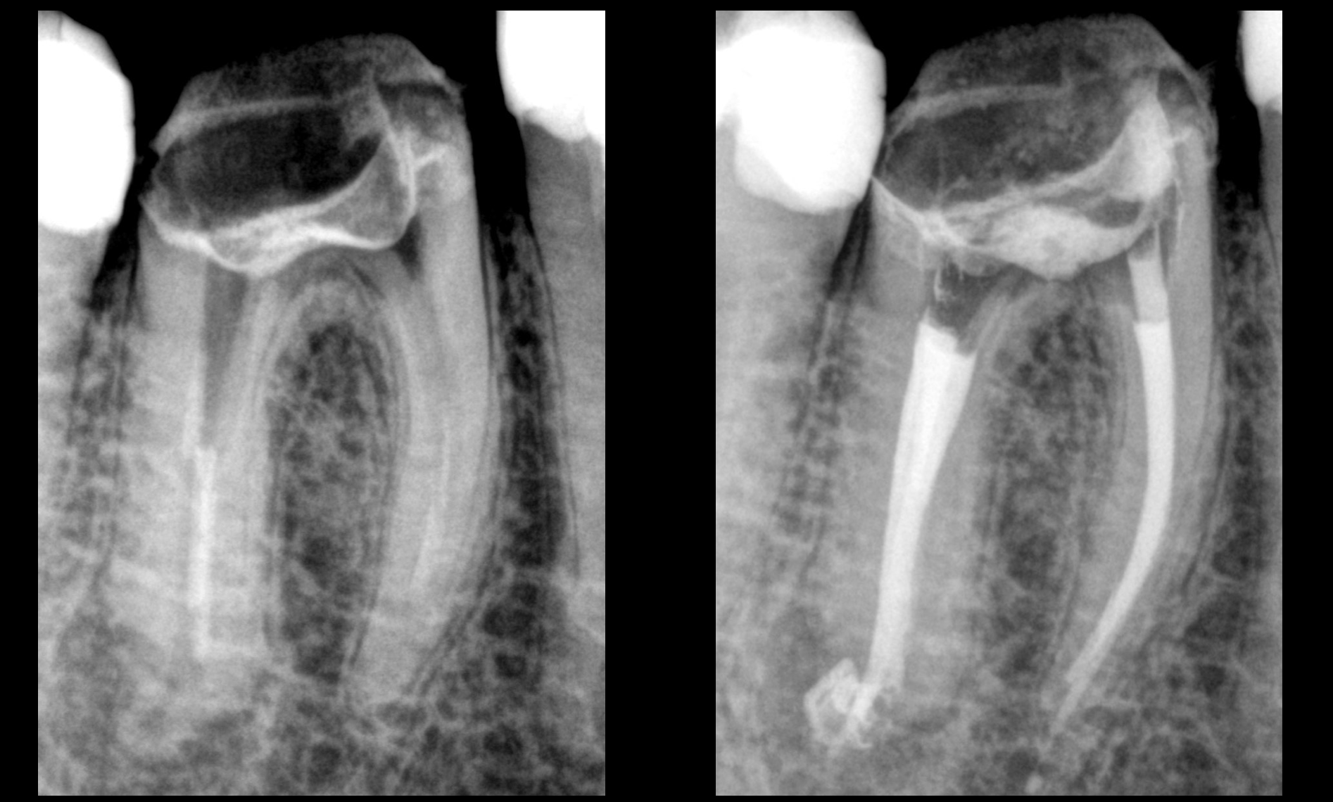 Radio-opacité des biomatériaux d'obturation canalaire - Dr Brice Riera