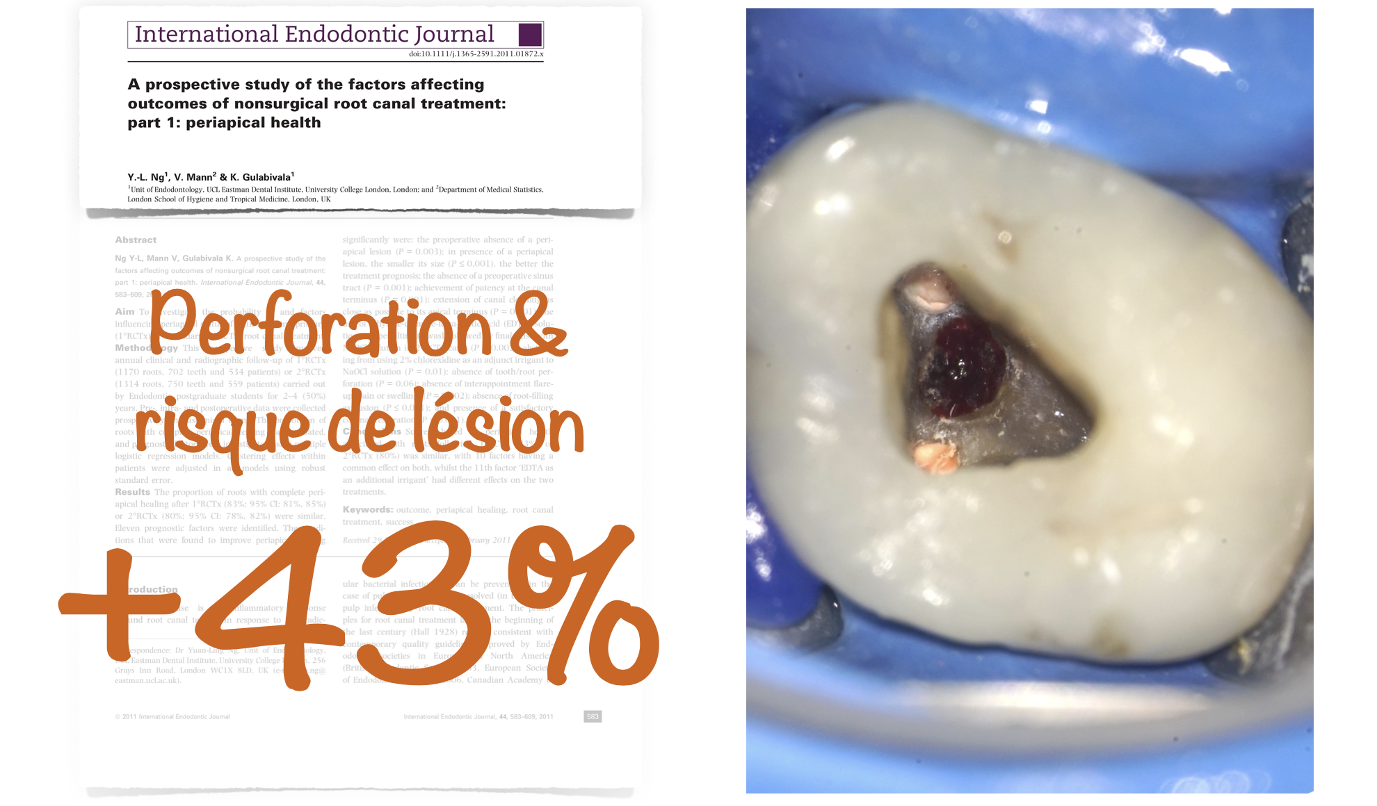 Perforation non traitée et risque de lésion apicale - Dr Brice Riera