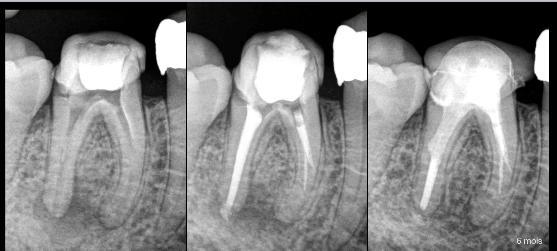 Le traitement endodontique parfait n'existe pas - Dr Brice Riera