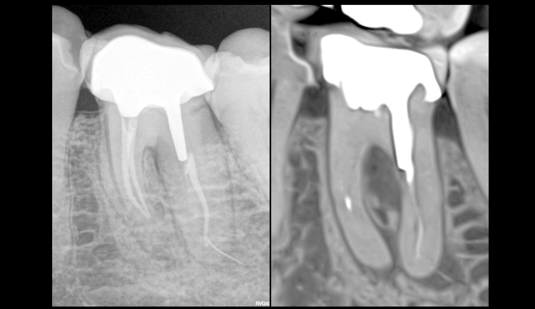 7 éléments à relever sur cette dent 36 - Dr Brice Riera