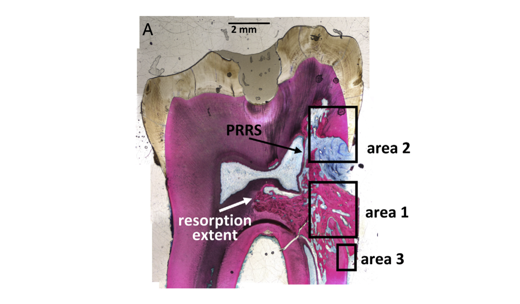 Tissu dentaire et résorption radiculaire externe cervicale - Dr Brice Riera